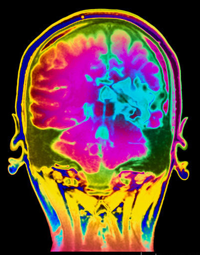 Colour MRI brain scan of arteriovenous malfunction - Relatietherapie ...